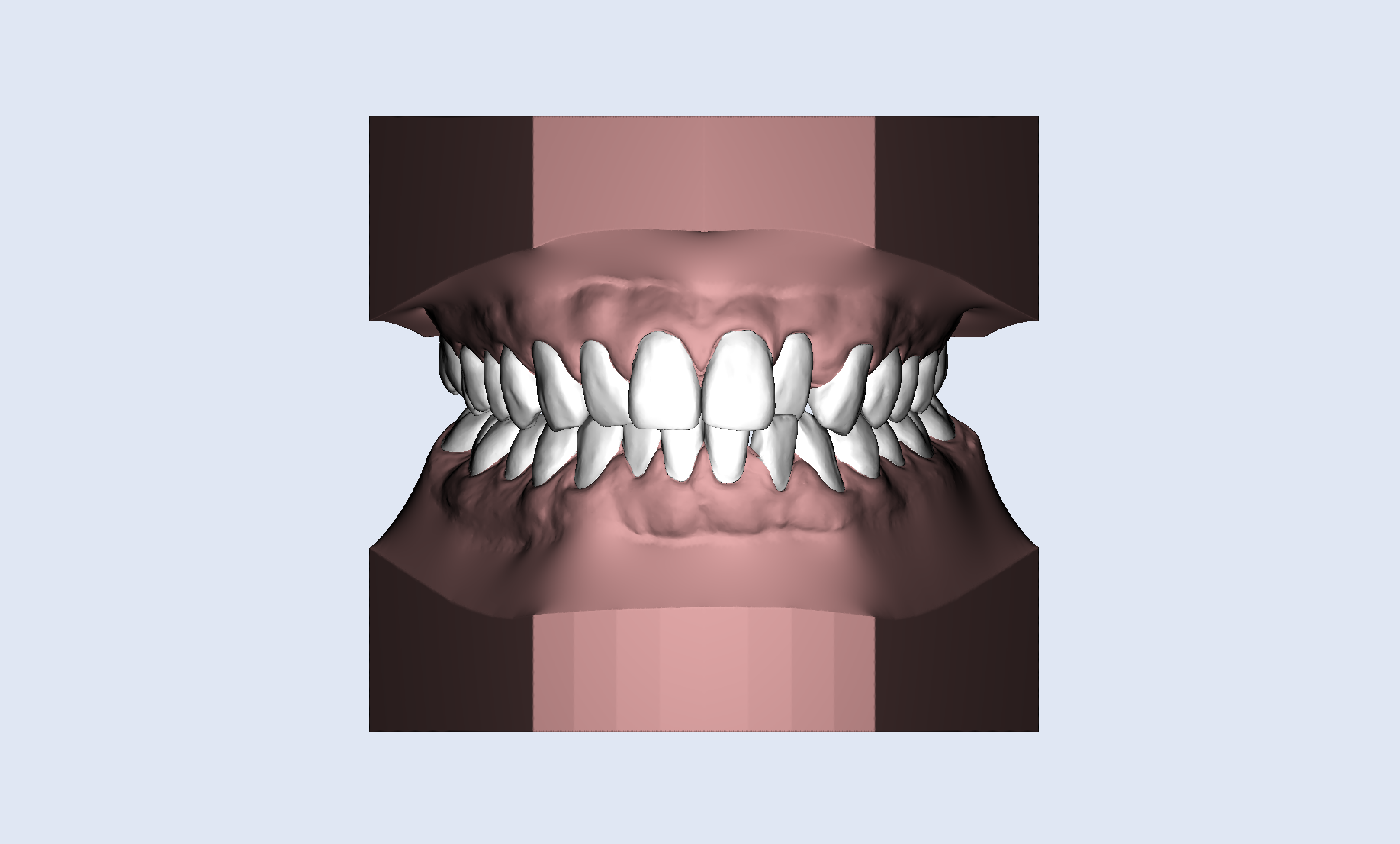 9. Simple Crossbites