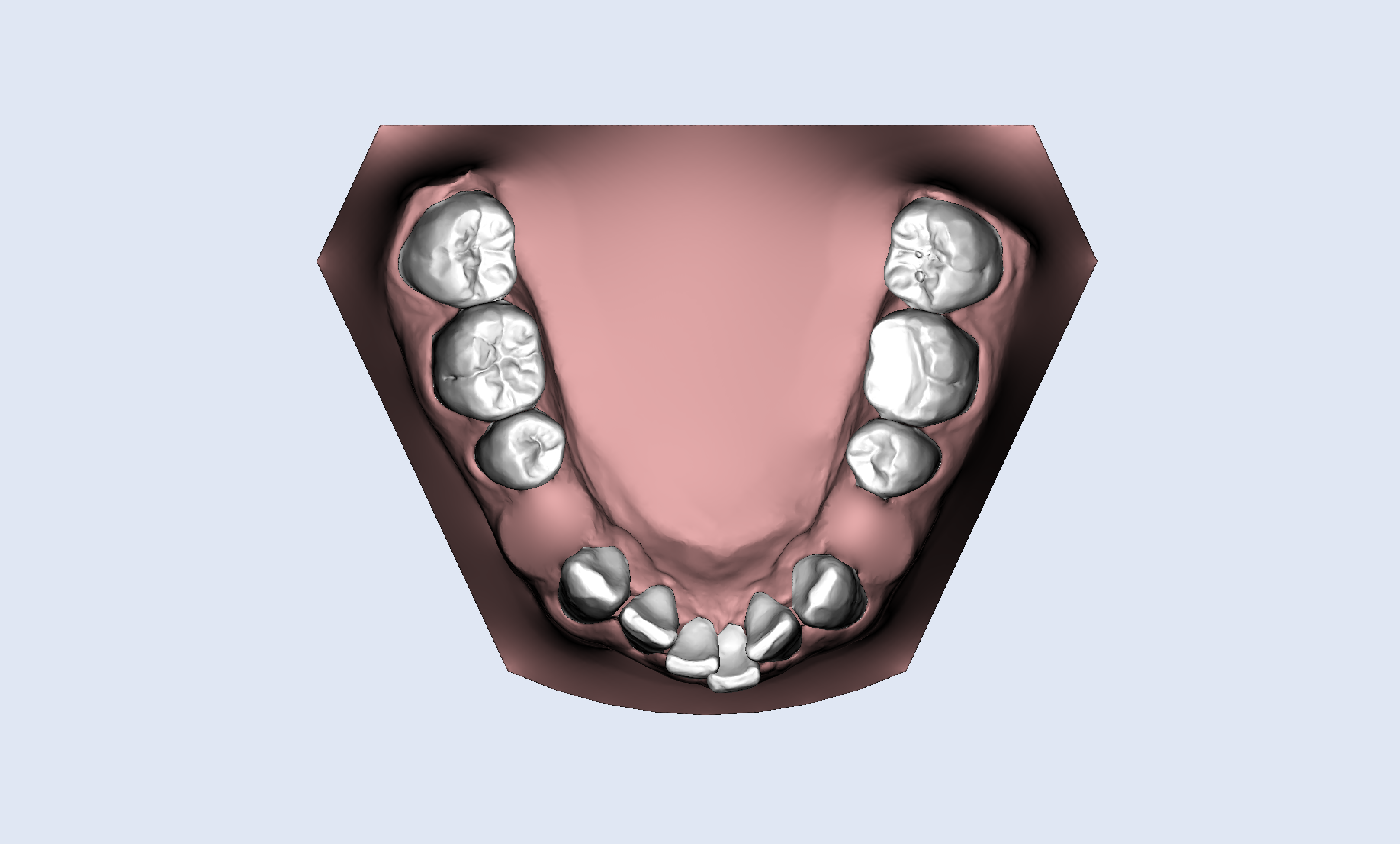 6. Bicuspid Extraction