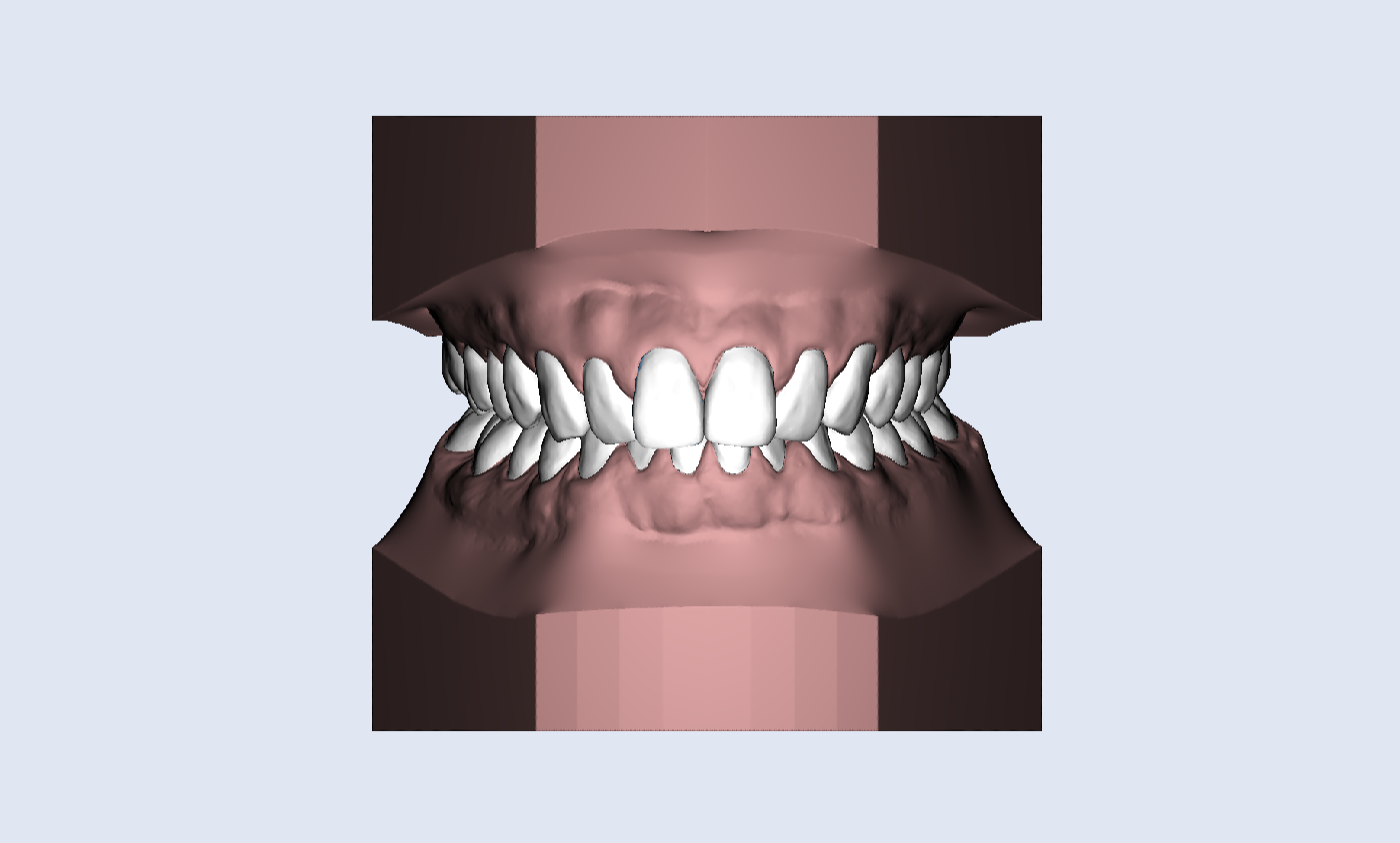 6. Advanced Deep Bite