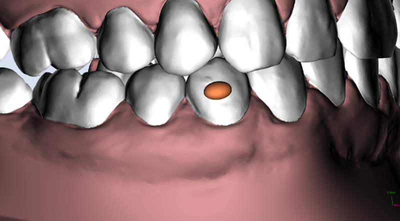 It is important to inform ALL patients that attachmnets may be bonded ...