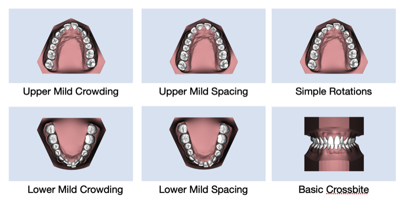 Minor Orthodontic Relapse