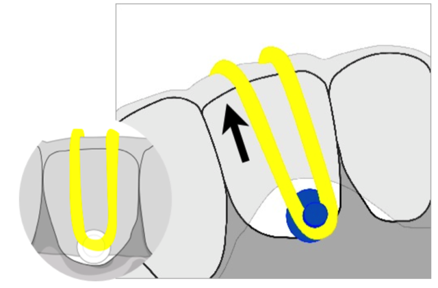 A lingual button bonded to the tooth and a hook on labial of the ...