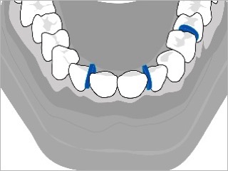 This image shows the use of orthodontic separators prior to IPR